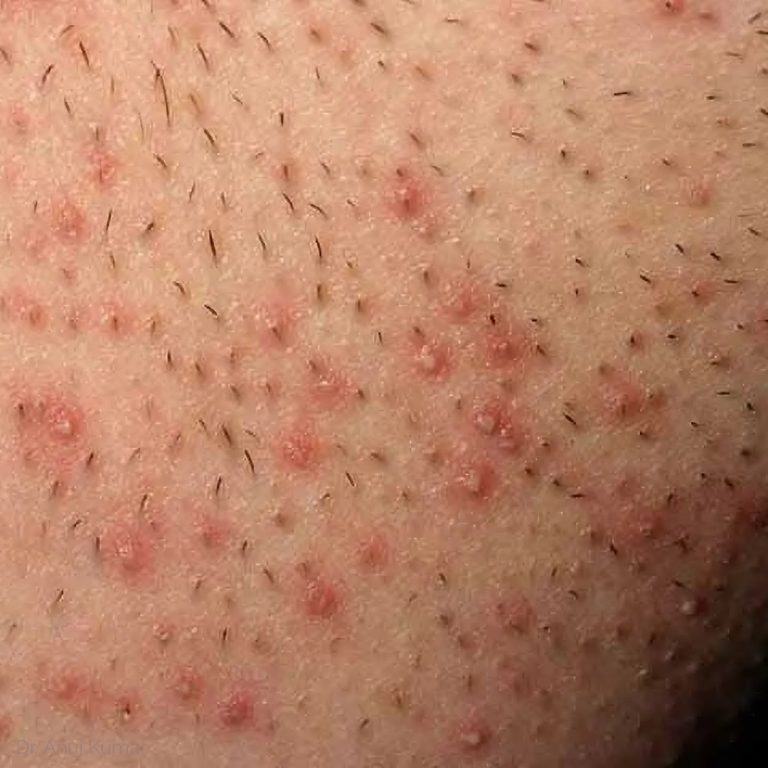 Razor Bump Treatment – Dr. Anuj Kumar