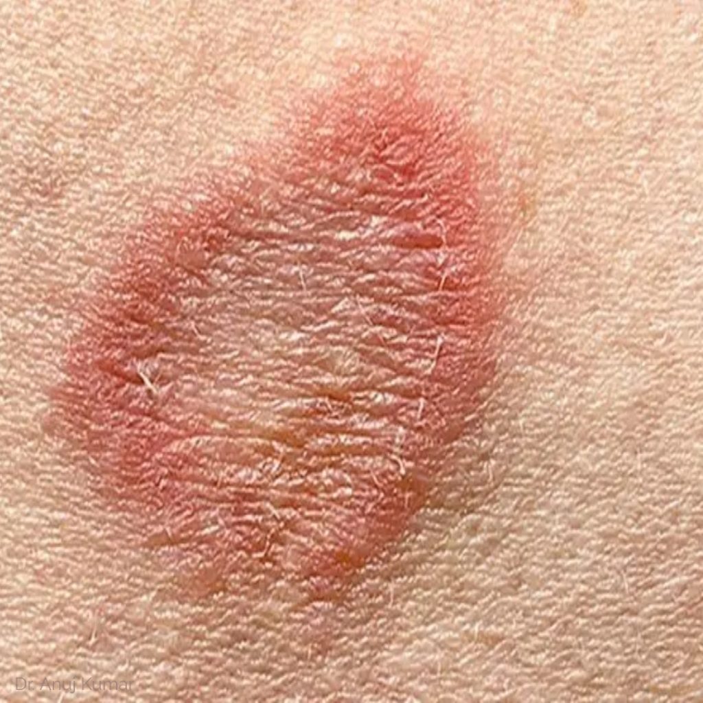 Ringworm Treatment – Dr. Anuj Kumar